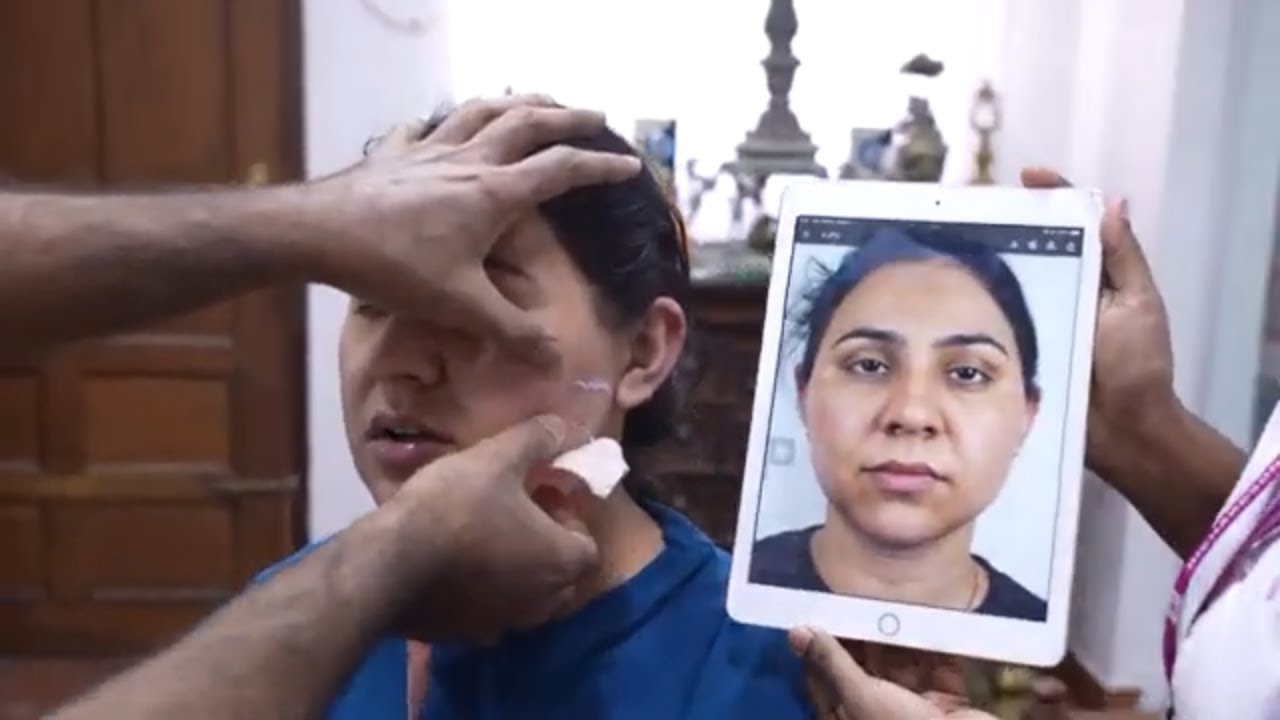 Amazing Transformation After 1 Week of JAW Surgery | Splint Removal ...