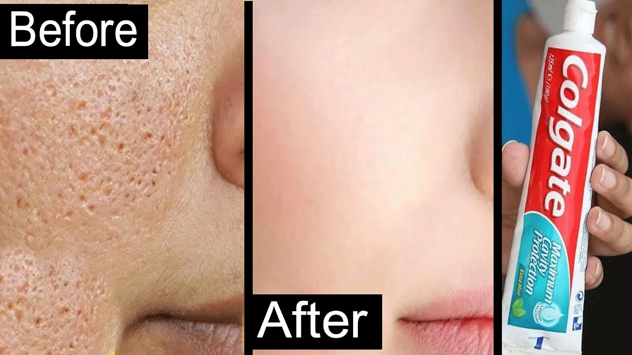 Skin Whitening Treatments At Home With Colgate Toothpaste - YouTube