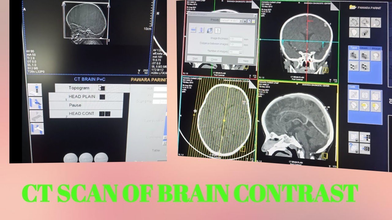 CT SCAN OF BRAIN PLAIN AND CONTRAST 💉 HAND PUSH CONTRAST 💉. - YouTube