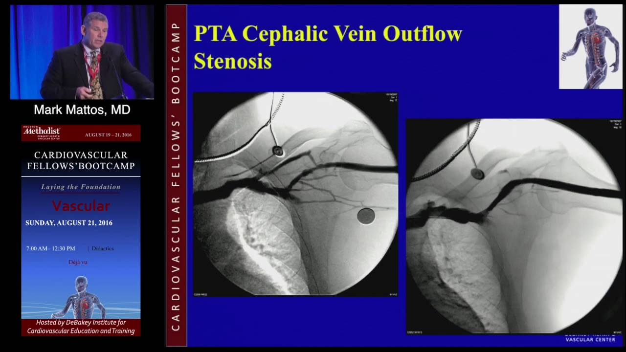 Management and Access Stenosis and Occlusion (Mark Mattos, MD) - YouTube