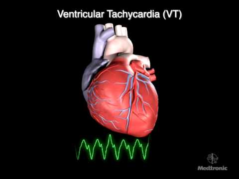 Ventricular Tachycardia - YouTube