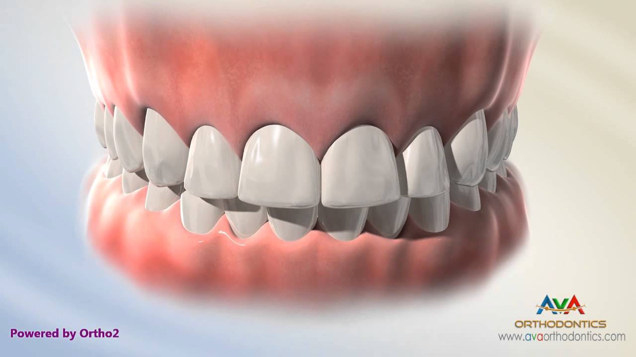 Orthodontic & Restorative Treatment for Small or Peg Lateral Incisor ...