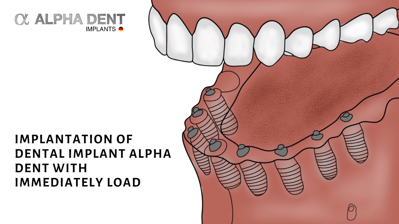 Dental implants surgery. Implantation of dental implant AlphaDent with ...