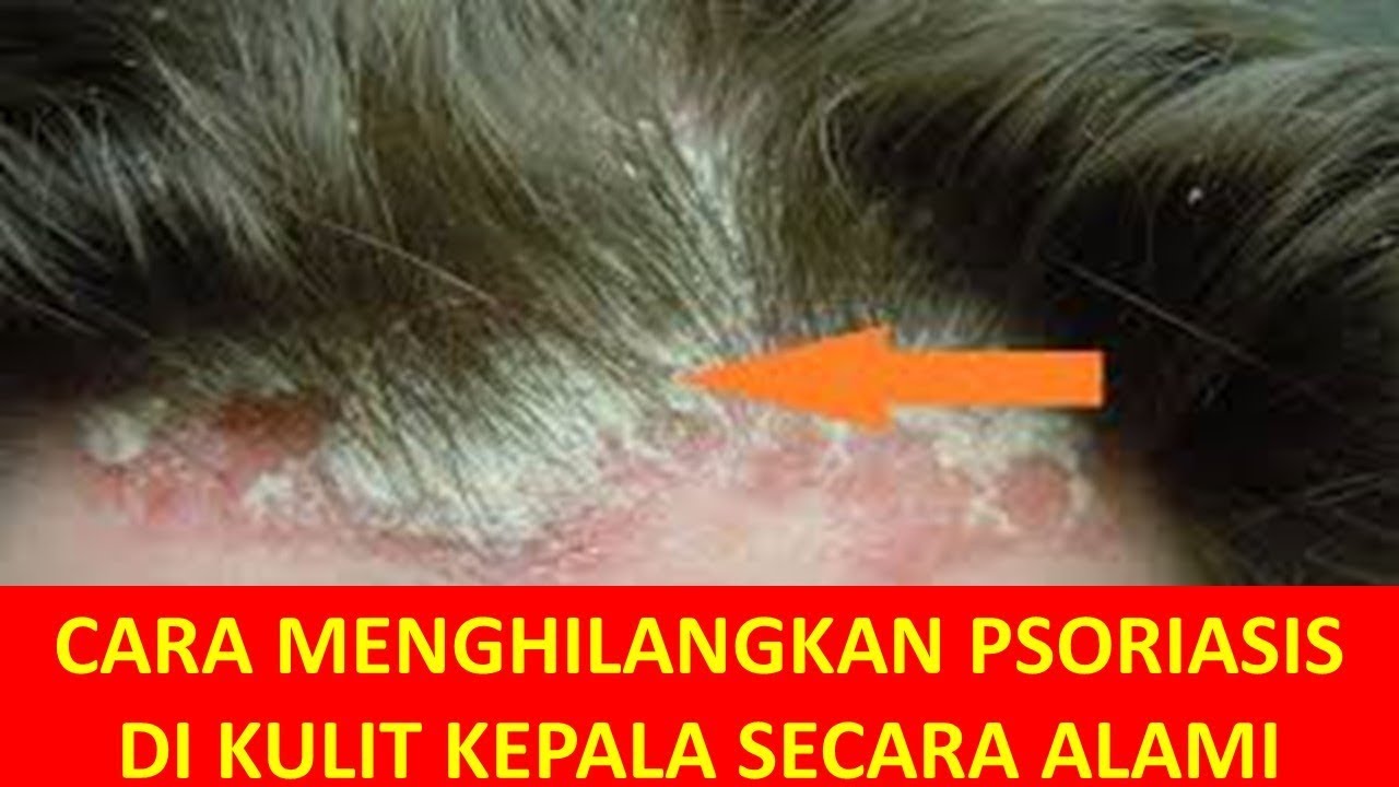 cara menghilangkan psoriasis di kulit kepala secara alami - YouTube