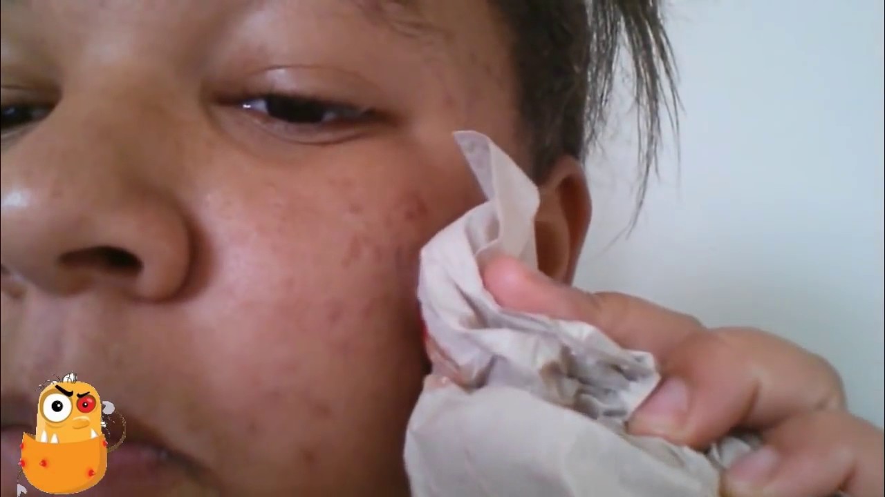 Popping Large Cyst On Face, So Much Pus Coming Out! 2016 - YouTube