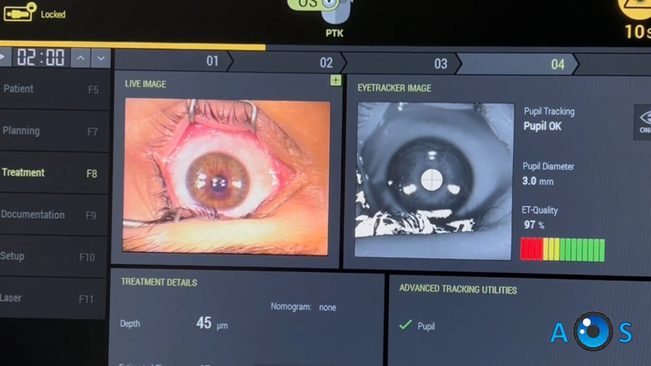 Contoura PRK & Corneal Crosslinking for Treatment of Keratoconus ...