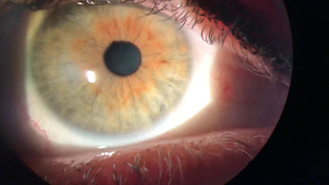 Nistagmus Rotatorio - YouTube
