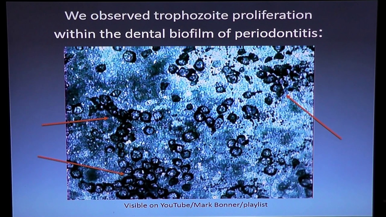 Cure Periodontitis Antiparasitic and Microscopic Method Dr Bonner - YouTube