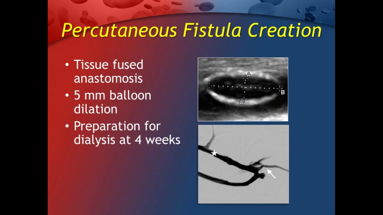 U.S. Ellipsys® Registry - YouTube