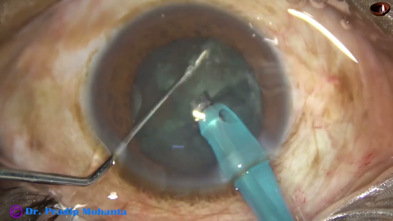 Divide and conquer technique for a soft cataract when Rhexis is small ...