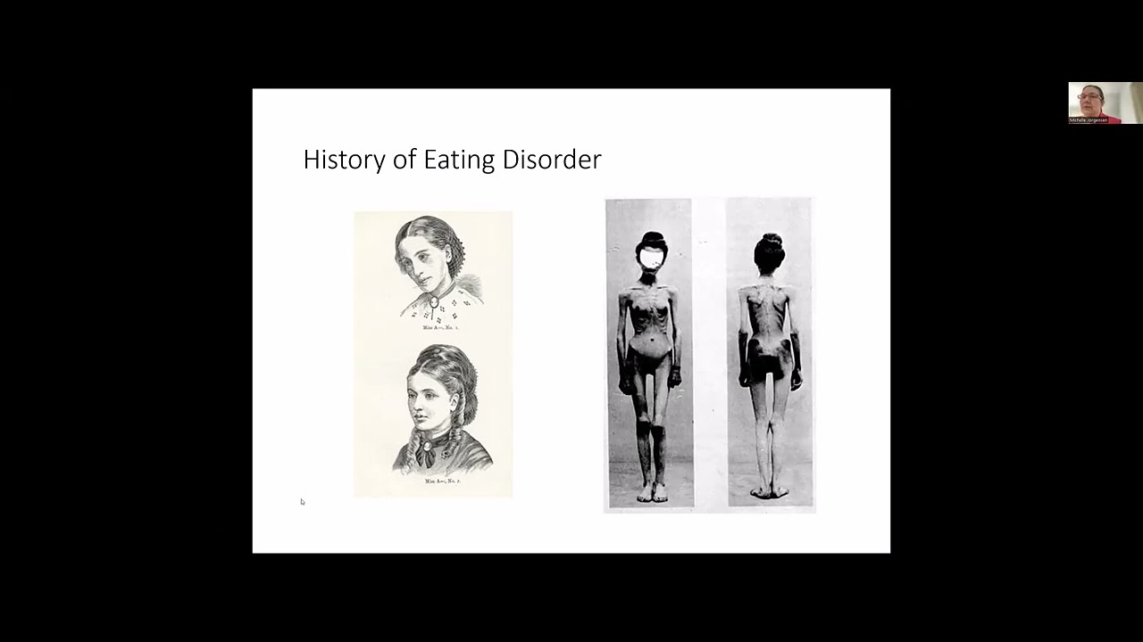 Pediatric Eating Disorders - YouTube