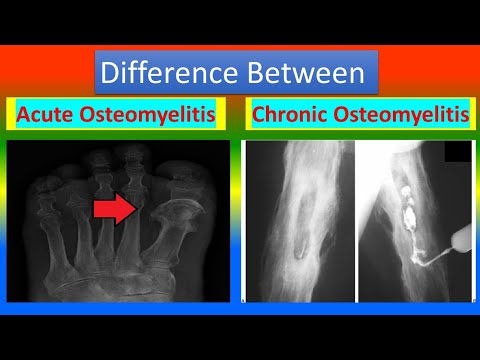 Difference between Acute Osteomyelitis and Chronic Osteomyelitis - YouTube