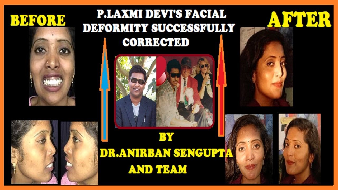 LAXMI REDDY(#telegu #HYDERABAD)ON HER#FACIAL_DEFORMITY_CORRECTION BY # ...
