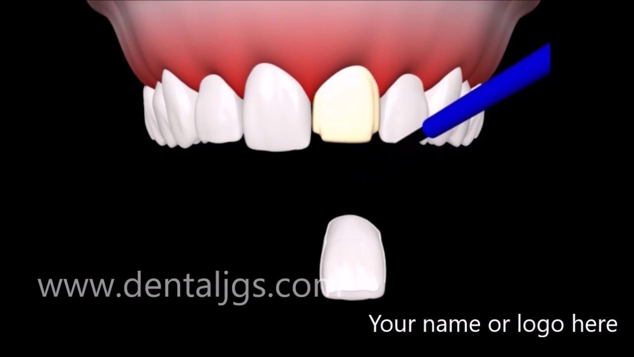 Dental Animation - Porcelain Veneer - Clinic Package - YouTube