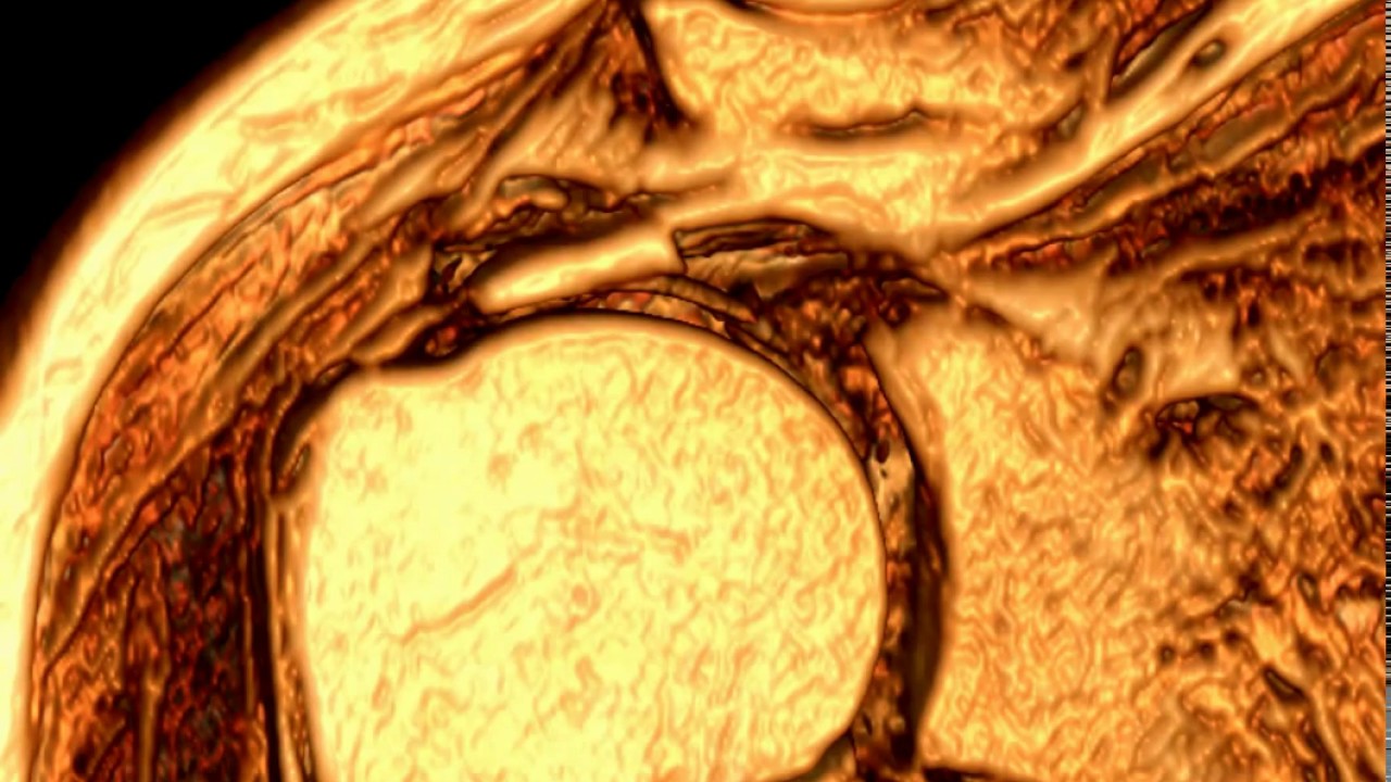 Full Thickness Rotator Cuff Retracted Tear - 3D MRI Finding - YouTube