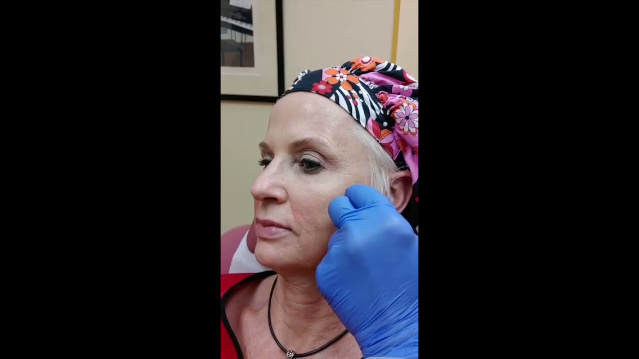 New Revance Filler for Brow Wrinkles - YouTube