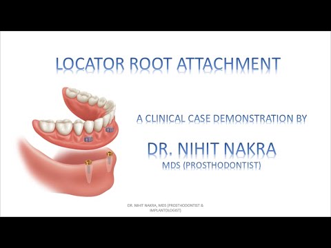 LOCATOR Root Attachment - YouTube