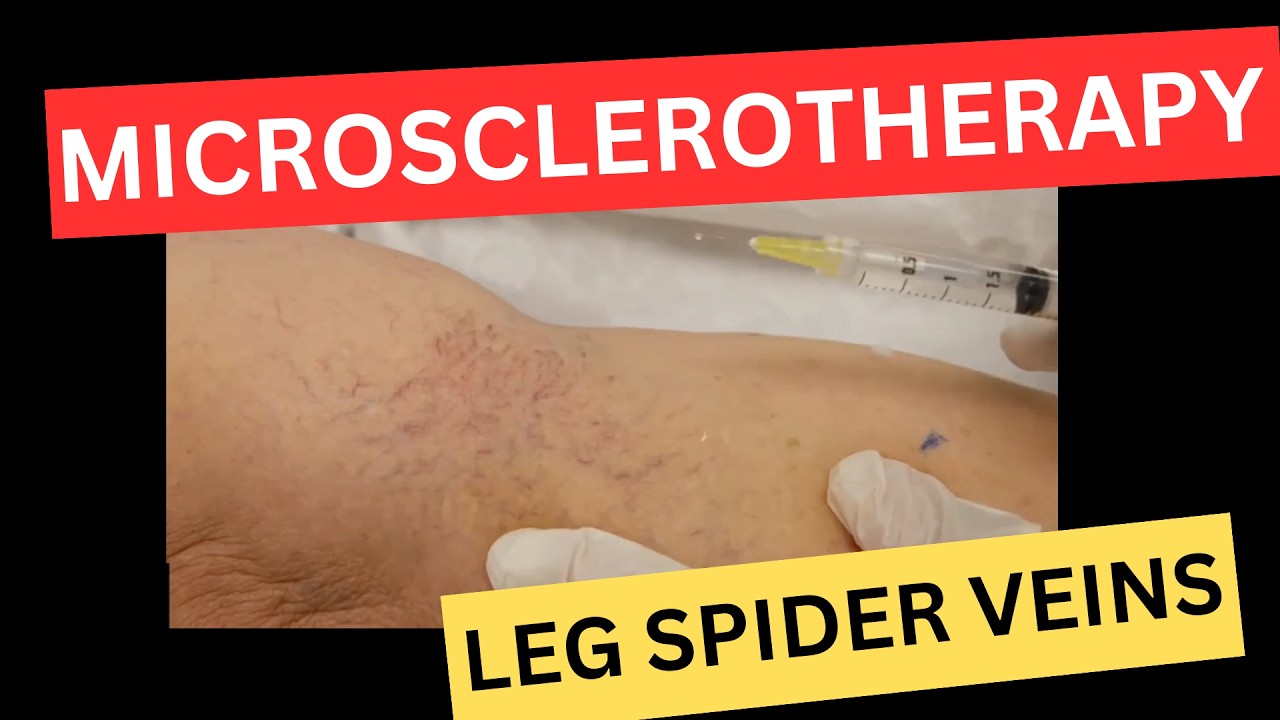 Microsclerotherapy Masterclass: How to Inject Spider Veins - A FREE ...
