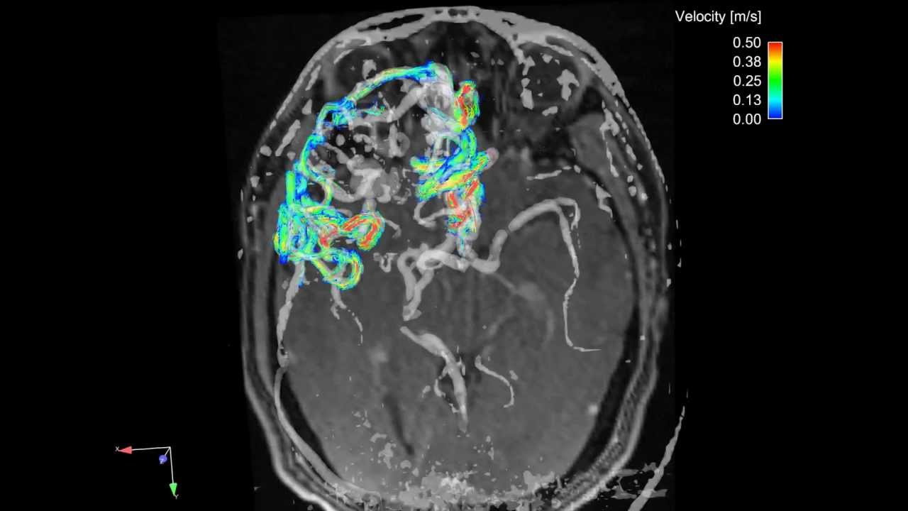 Intra-cranial 4D flow MRI - Complex 3D blood flow dynamics in a large ...