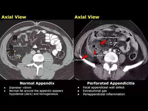 Appendix CT Scan Normal Vs Appendicitis Images | Acute, Gangrenous Types & Perforated Appendix ...