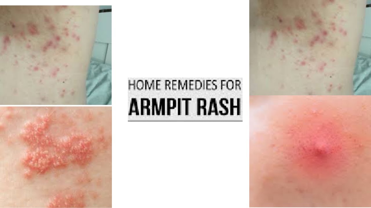 Can Armpit Rash Cause Other Complications Youtube