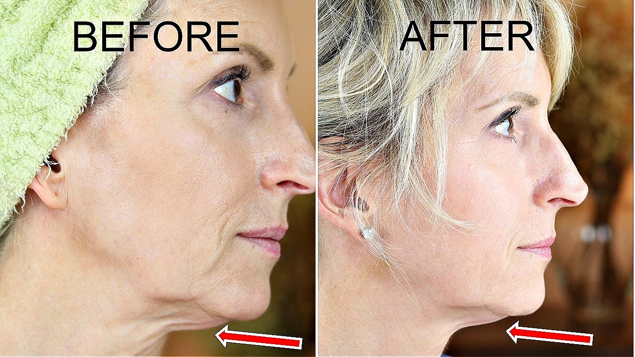 Skin Tightening Anti Aging Device Review | EvenSkyn LUMO | Before ...