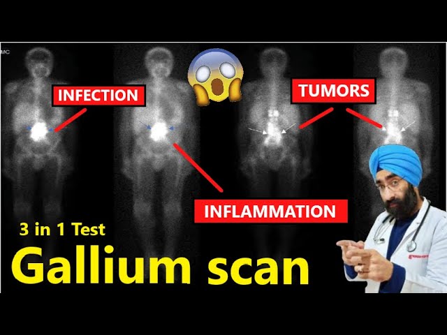 Diagnosis And Corresponding Gallium Scan