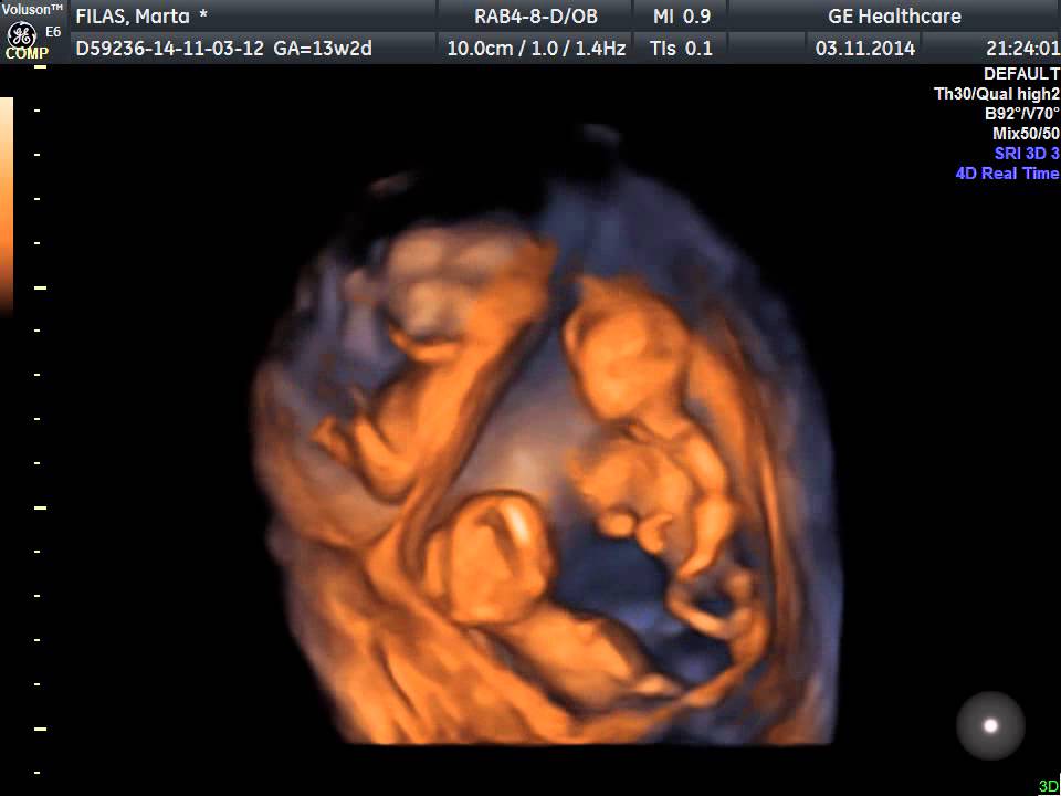 Trojaczki usg 4d - YouTube