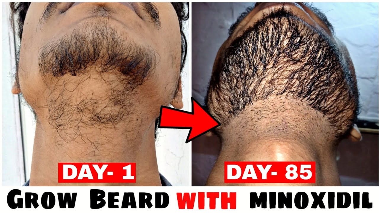 How to Grow a Beard with Minoxidil: Effective Growth Tips & Tricks