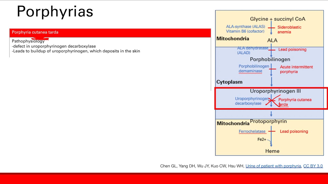 Porphyrias | Hematology | Step 1 Simplified - YouTube