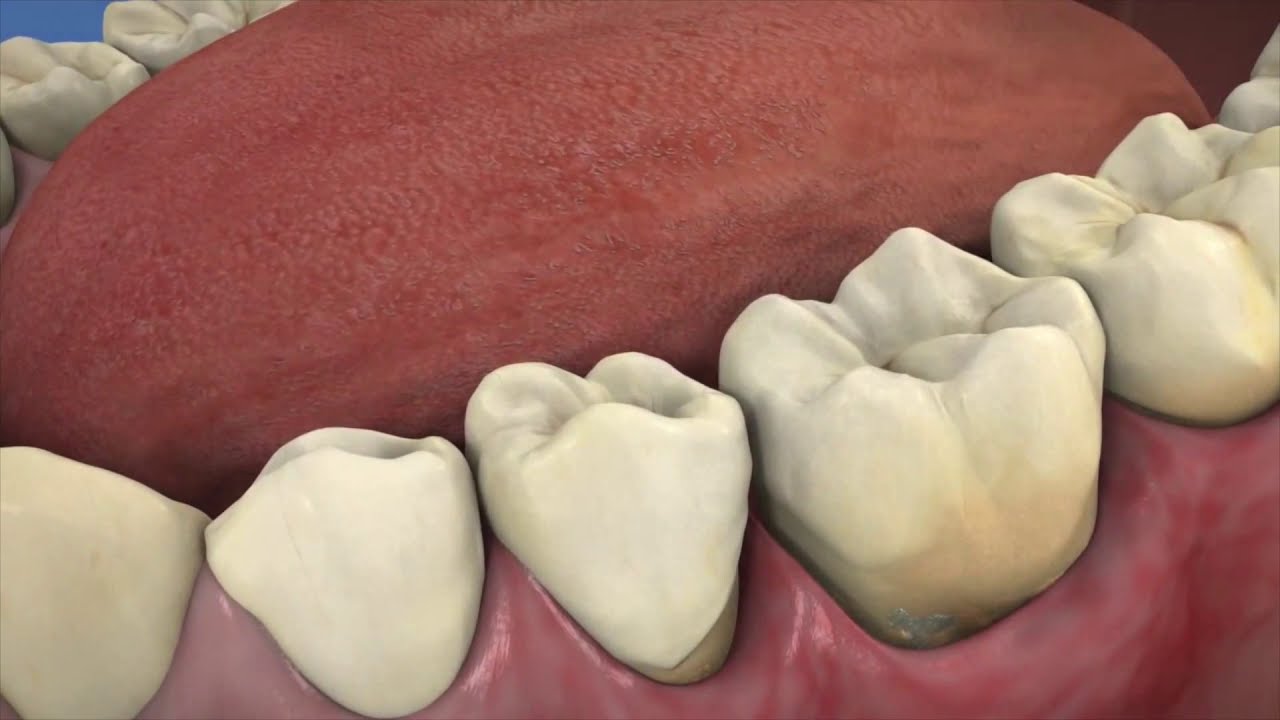 The Role of ARESTIN® in Periodontal Treatment - YouTube