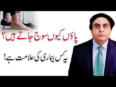 Swollen feet: Causes, Treatments, and Home Remedies | Dr. Khalid Jamil