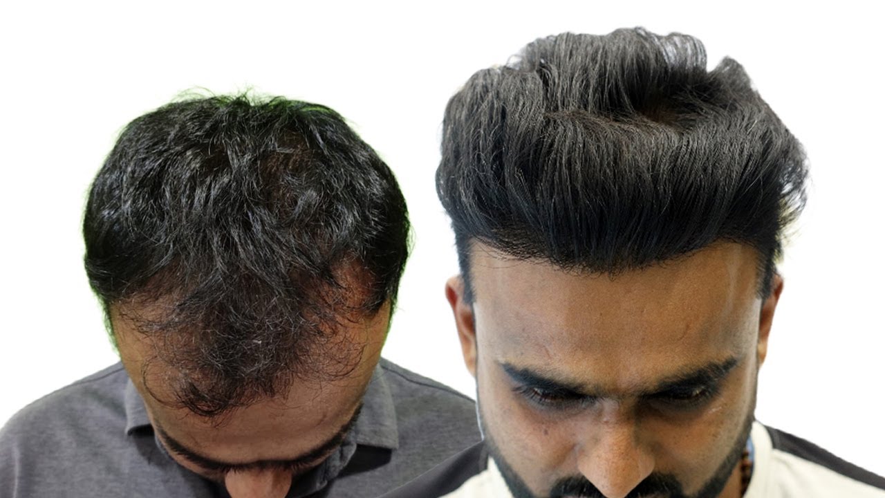 Thick Dense Hair Even After 3 Years Of Hair Transplant YouTube thick-dense-hair-even-after-3-years-of-hair-transplant-youtube