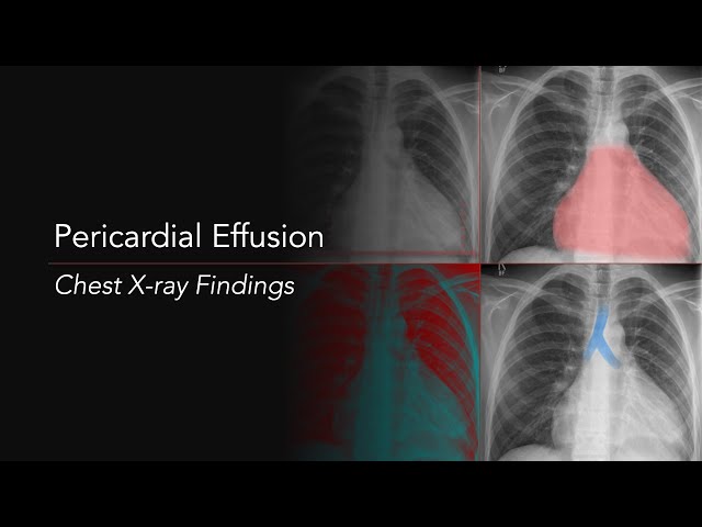 Water Bottleshaped Heart Pericardial Effusion With Cardiac Tamponade