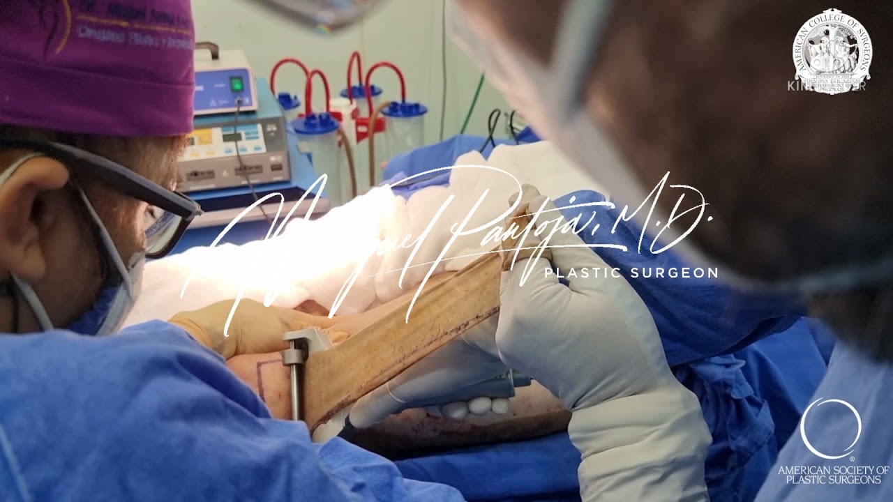 Toma de Injertos de Piel (espesor parcial, con Dermatomo eléctr.) en ...