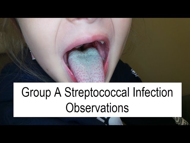 Strep Throat Tongue Bumps