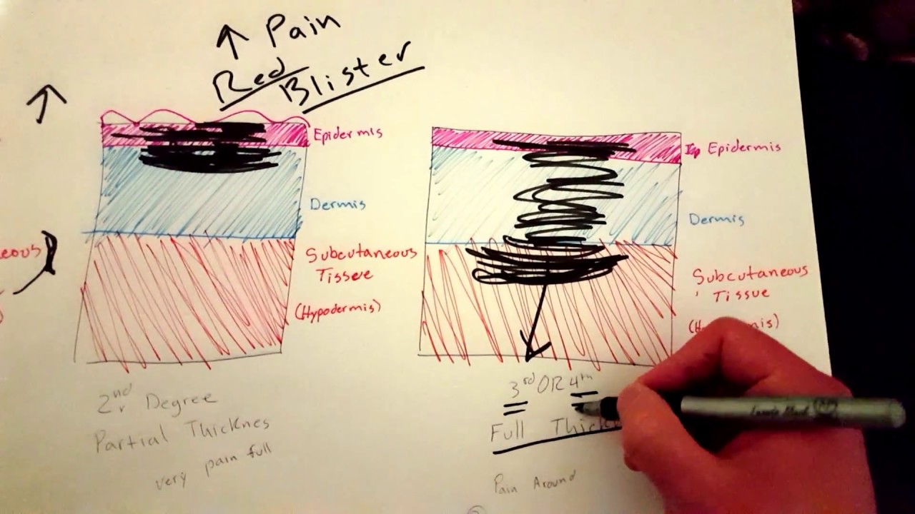 EMT Burns (1st, 2nd, & 3rd Degree) / EMT MADE EASY - YouTube