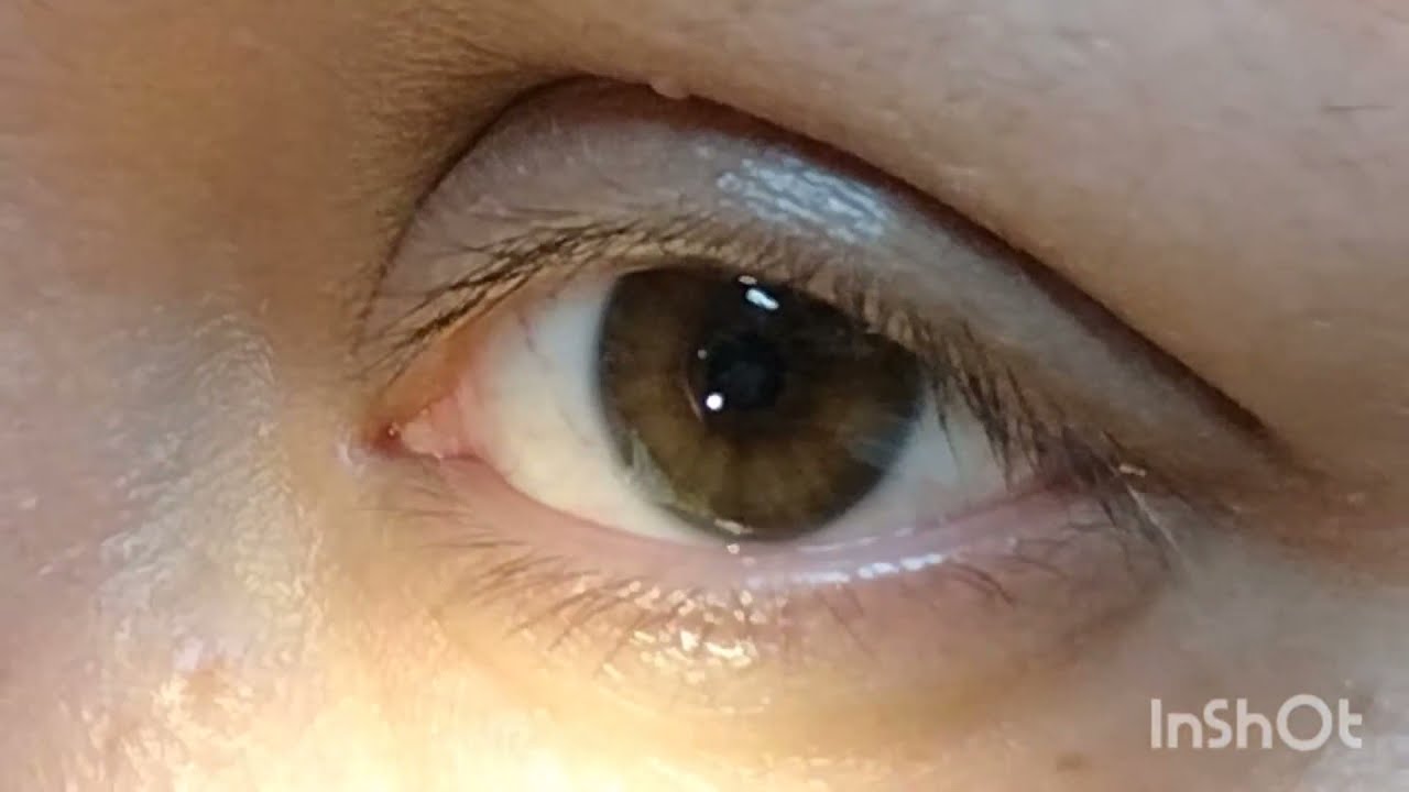 Reflejo Fotomotor/Motilidad ocular Intrínseca. (III,IV,VI PAR CRANEAL ...