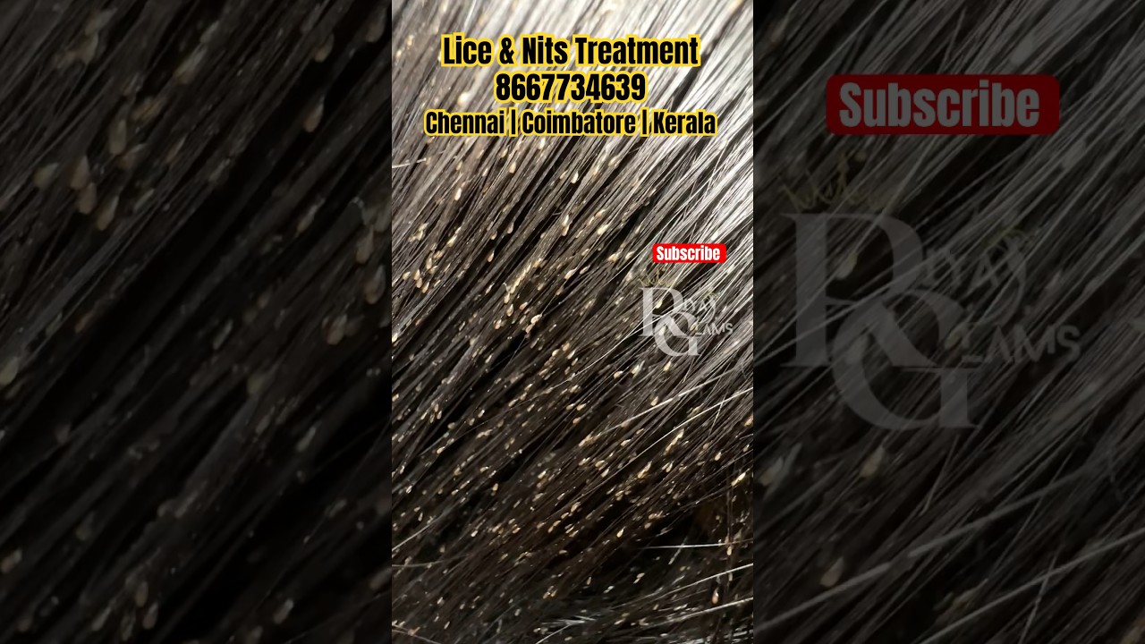 Lice nits removal treatment | lice treatment | lice removal | lice how ...