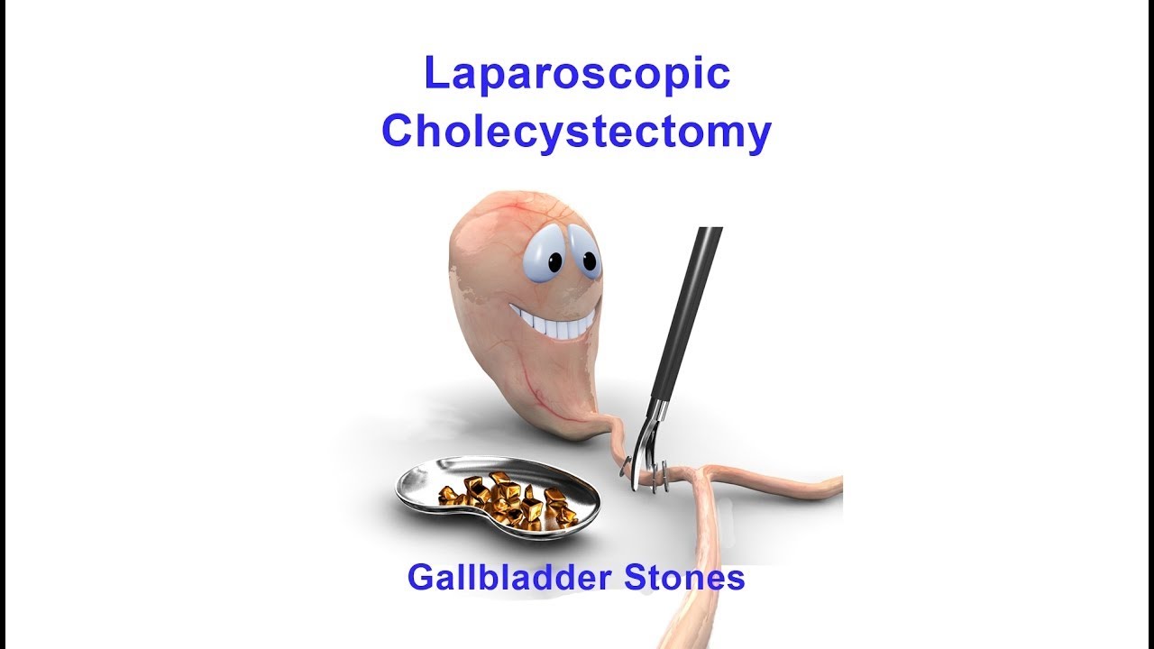 Gallbladder Removal Laparoscopic Cholecystectomy with Left Ventral ...
