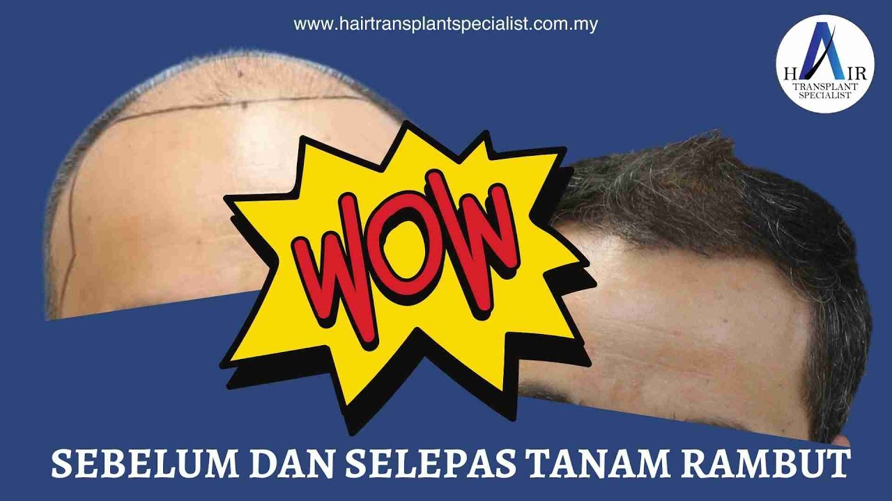 SEBELUM DAN SELEPAS TANAM RAMBUT l HAIR TRANSPLANT SPECIALIST - YouTube