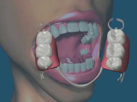 Prótese Parcial Removível com grampo metálico - PPR com armação ...
