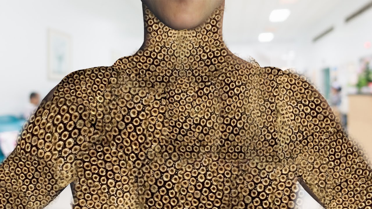 ASMR removal scorpion & trypophobia & insect infected chest & belly ...