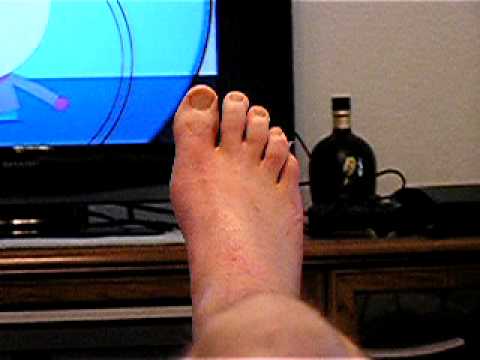 Shattered Calcaneus (Heel) 22 Days - YouTube