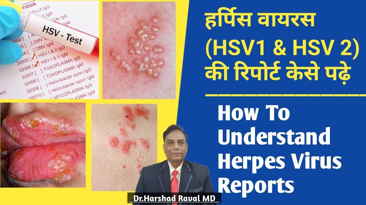 हर्पिस वायरस (HSV1 & HSV 2) की रिपोर्ट केसे पढ़े l How To Understand Herpes Virus Reports - YouTube