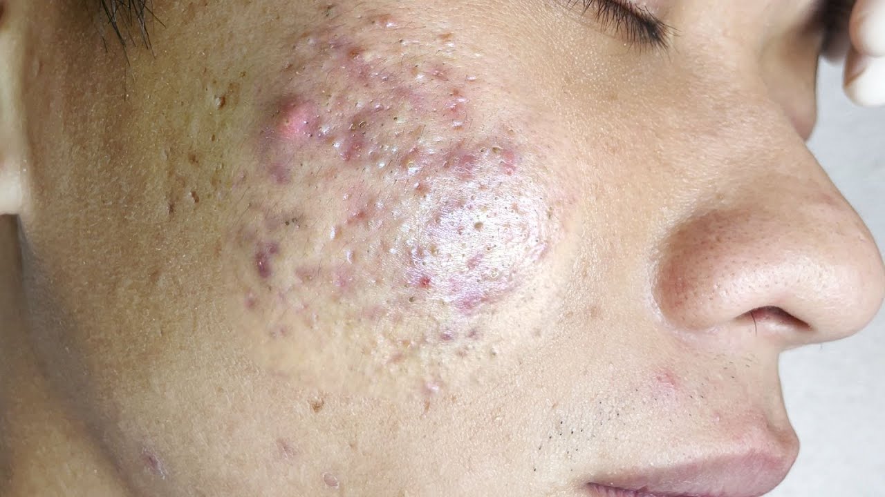 Suri Job #590: Awesome Removal Blackheads and Acne Hide under Skin ...