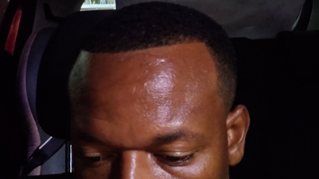 got at hair cut 2 days after pulling stitches from forehead - YouTube