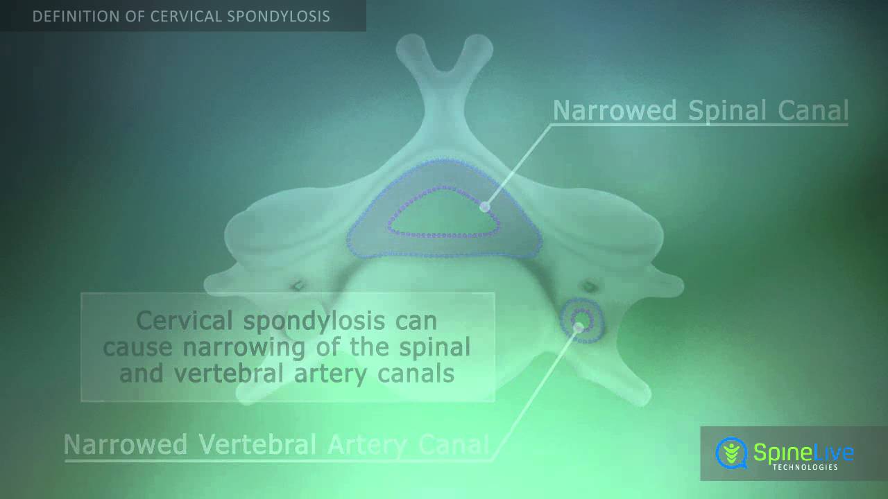 Cervical Spondylosis. Definition - YouTube