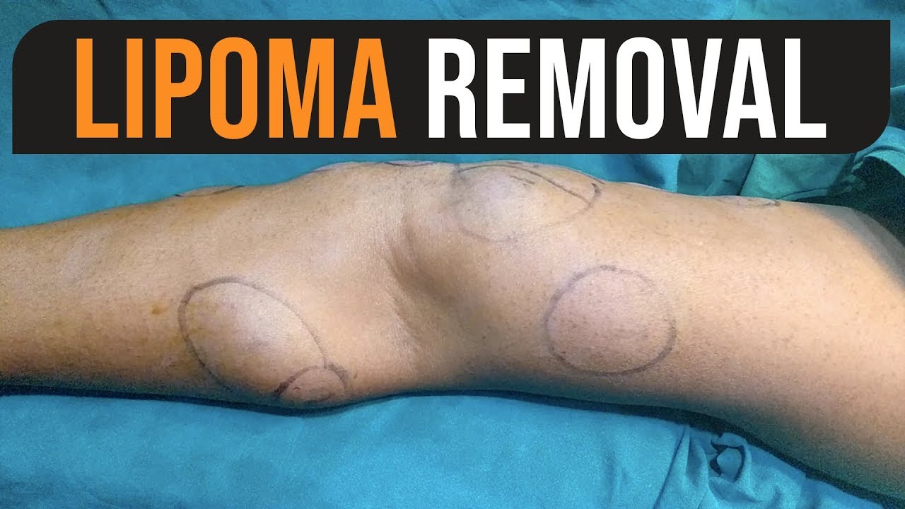 Goodbye Lipomas! | Scarless Procedure For Multiple Lipoma | Painless ...