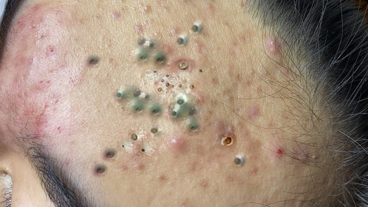 Pimplepopping #pimple #pimplepopping #shorts #popping #acnetreatment # ...